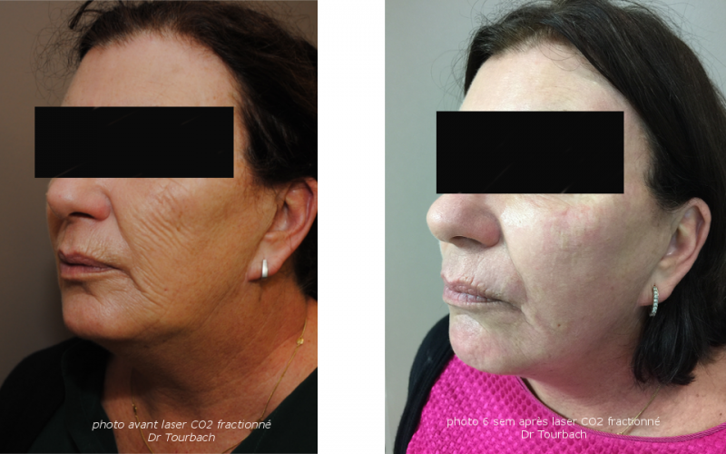 Traitement du visage par laser médical et peeling en Belgique