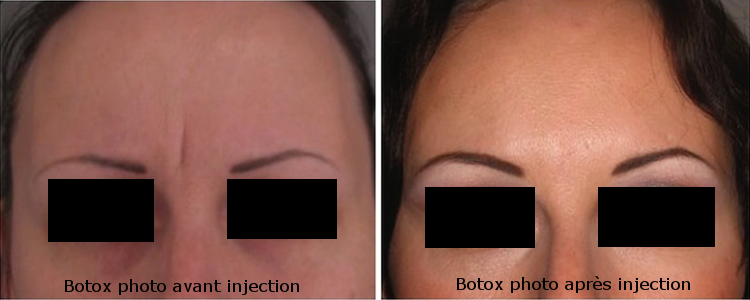 Injections de botox et acide hyaluronique par un chirurgien